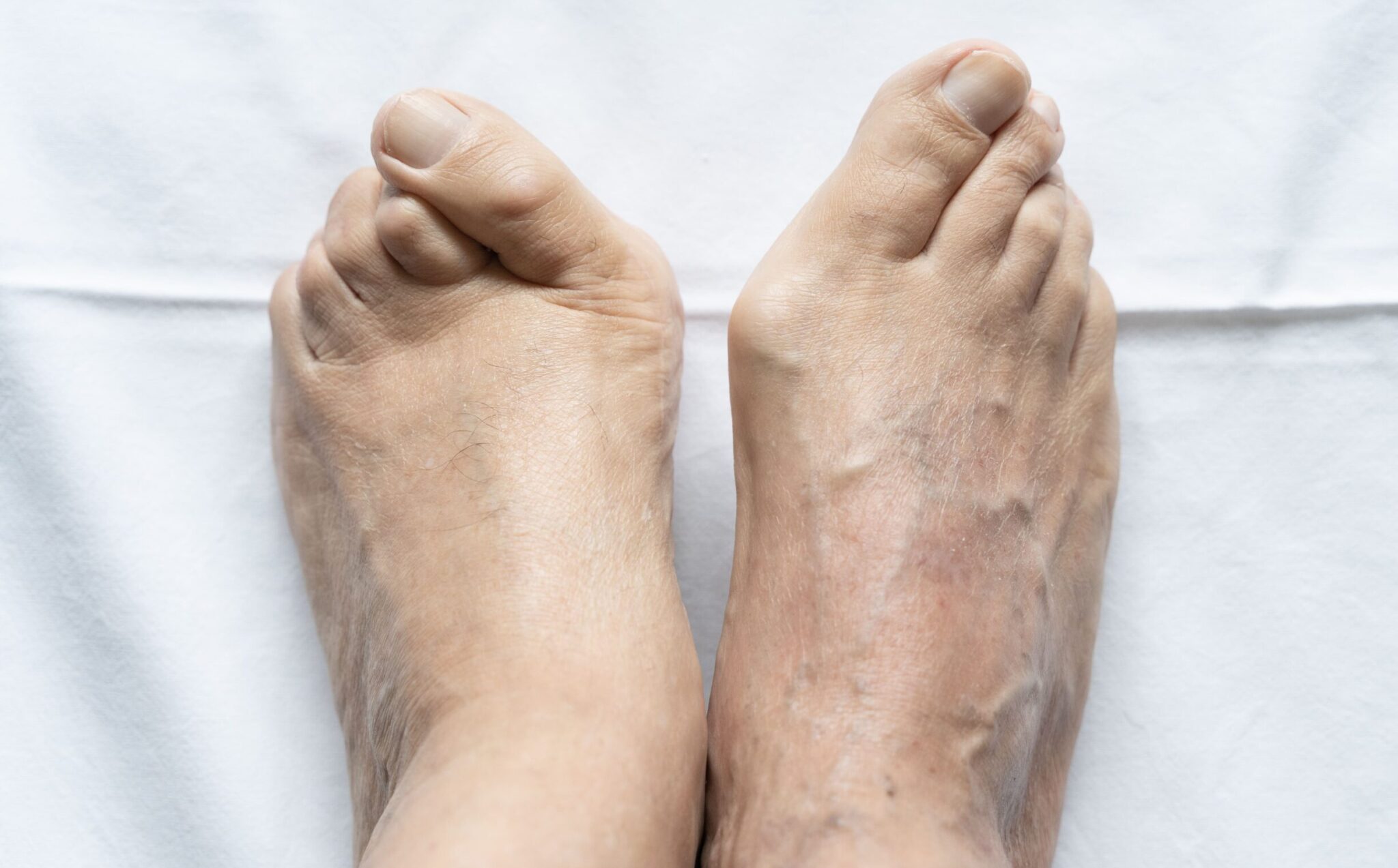 Fußarthrose behandeln - Schmerzlinderung & Mobilität | Arthrosezentrum