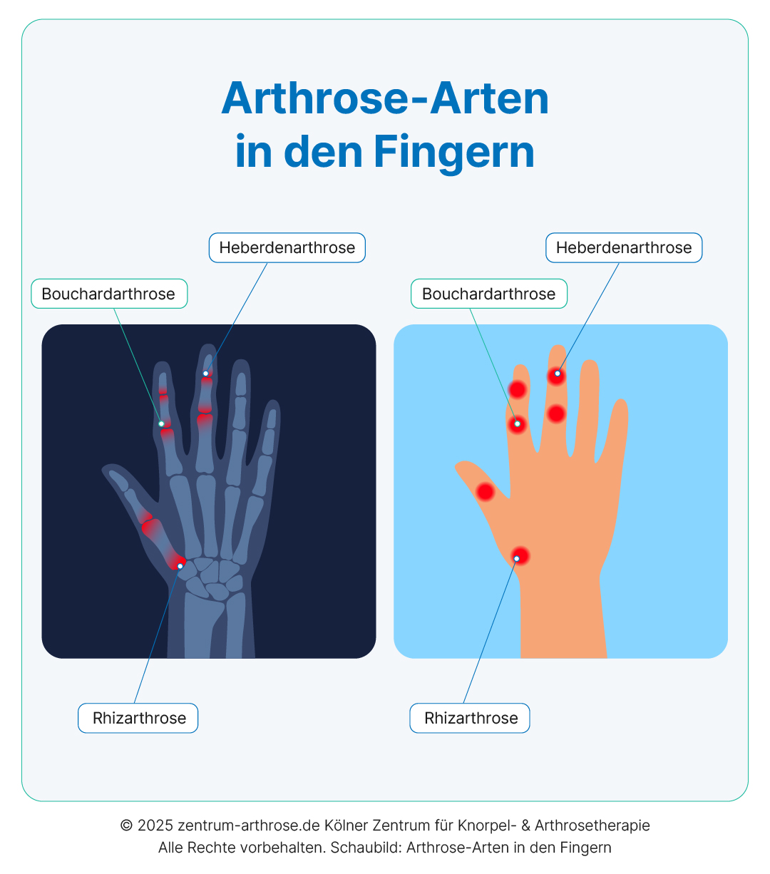 Bouchard-Arthrose behandeln | Arthrosezentrum Köln